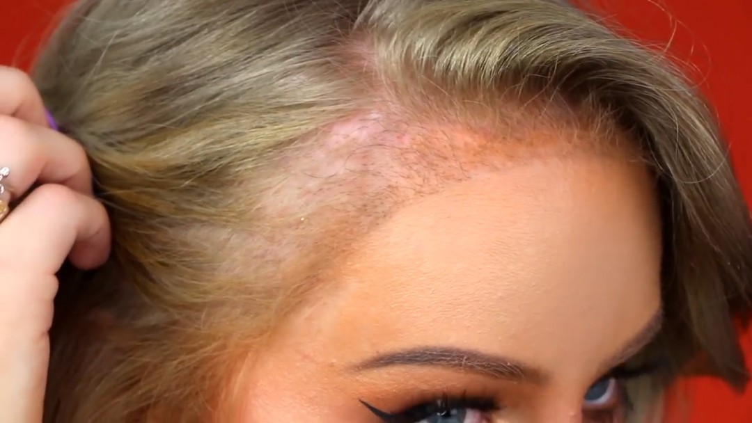 Transgender Hair Transplant | Hair Restoration | Ziering Medical