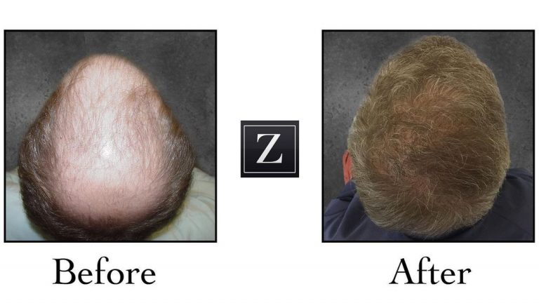 Male Hair Transplant Before And After Photos Ziering Medical