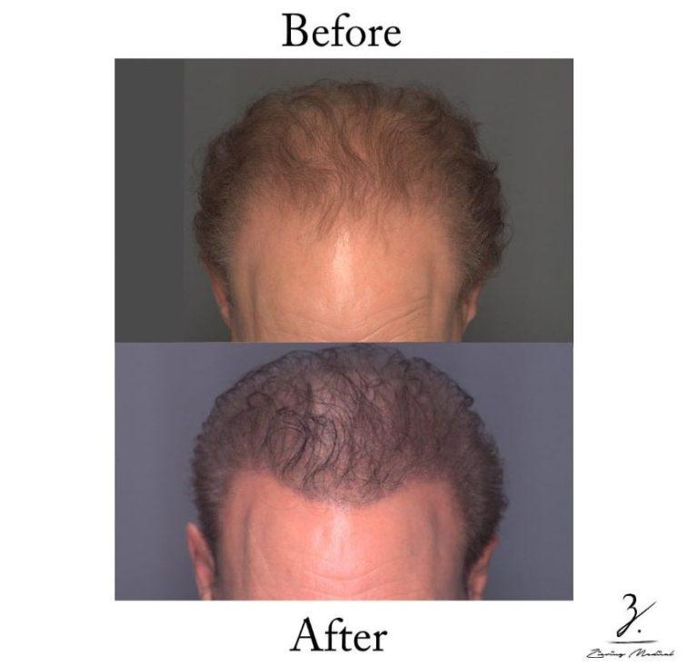 7 Ways to Stop Balding Without Surgery | Ziering Medical Blog