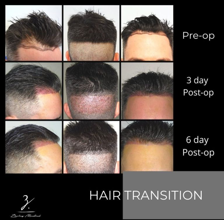 What Is a FUE Hair Transplant? | Complete Guide & Tips